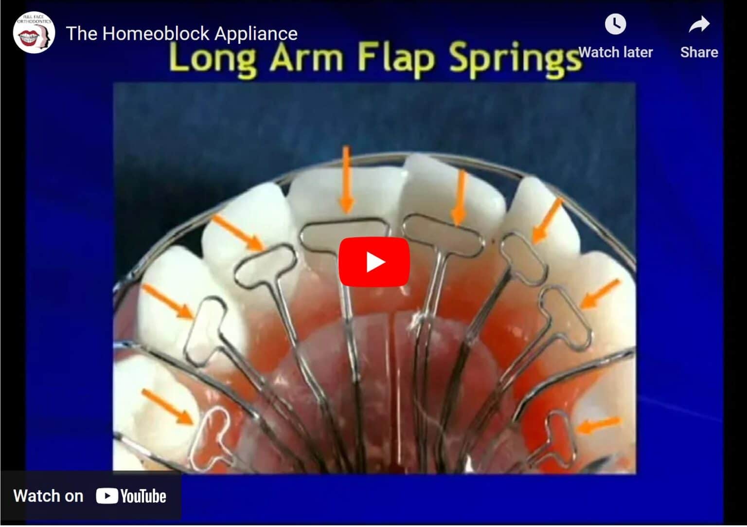 Homeoblock Appliance and Its Impact on Airway Health